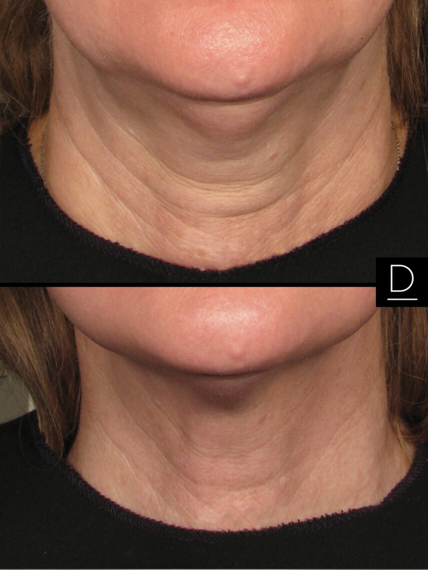 Tech Neck : How to Get Rid of It?