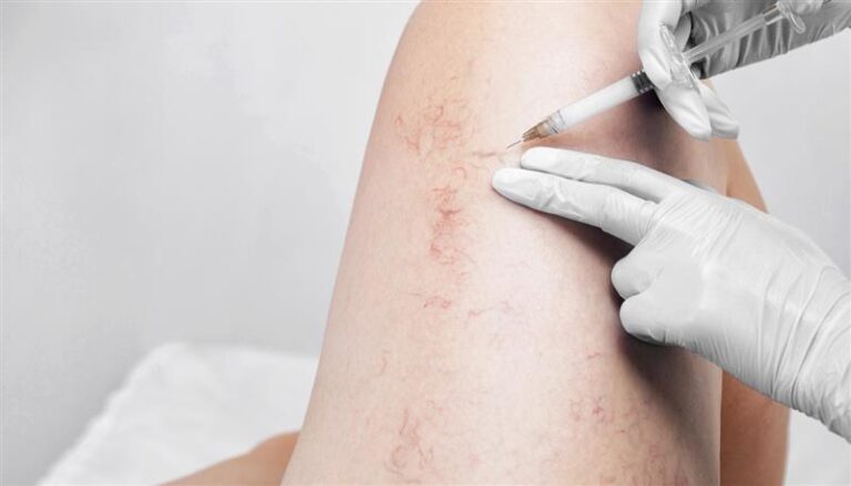 Visible Blood Vessel Under the Skin: Causes & Treatment