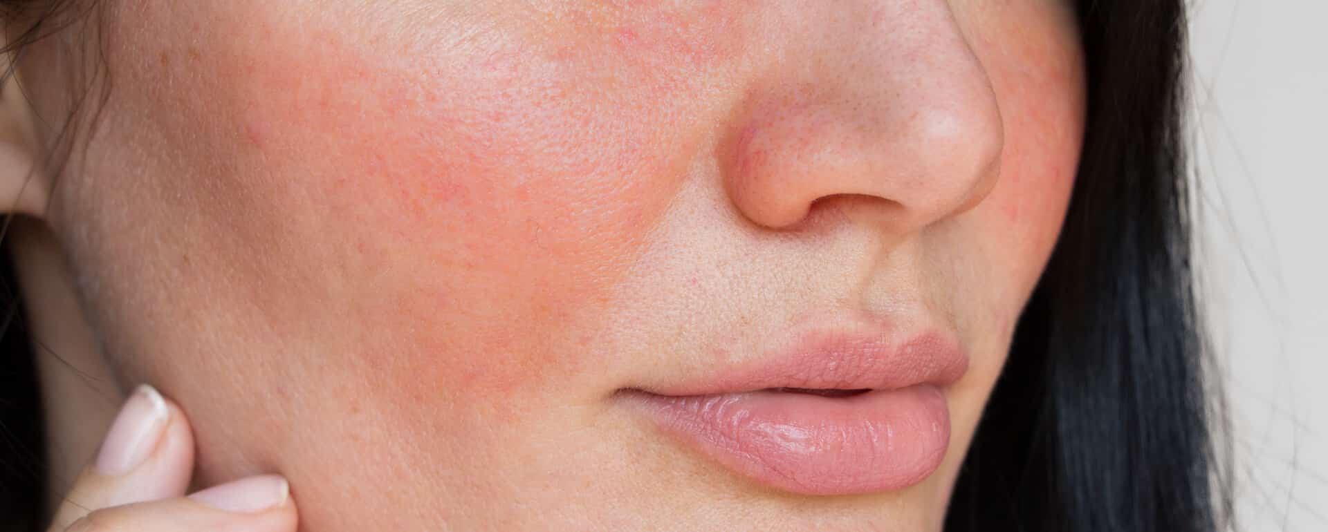 Demystify rosacea with Dr.Weksberg