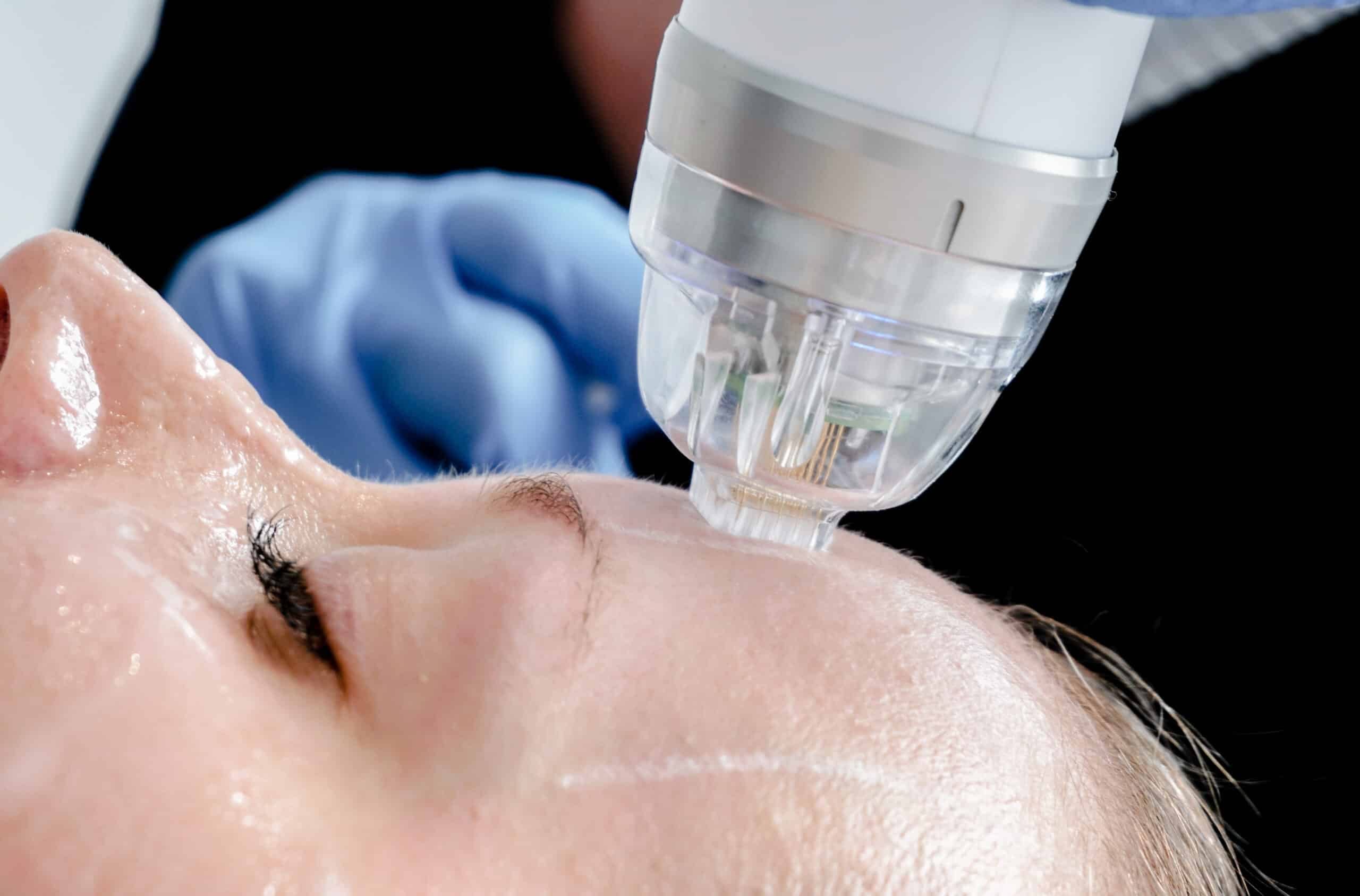 RF Microneedling: everything you need to know about the new Dermapure ...