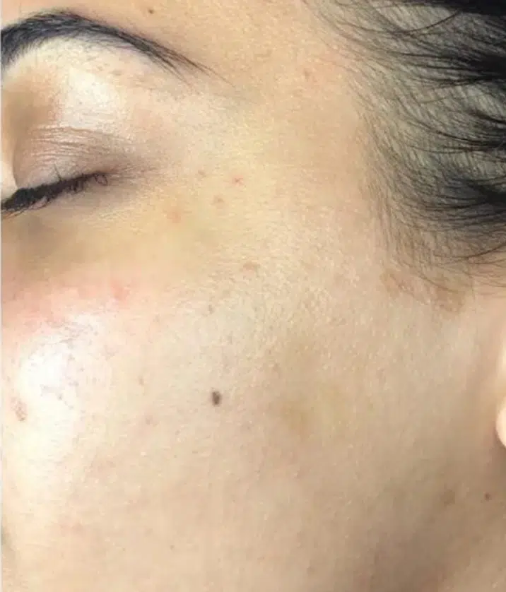 Dermaplaning Calgary Centre-ville | Dermapure