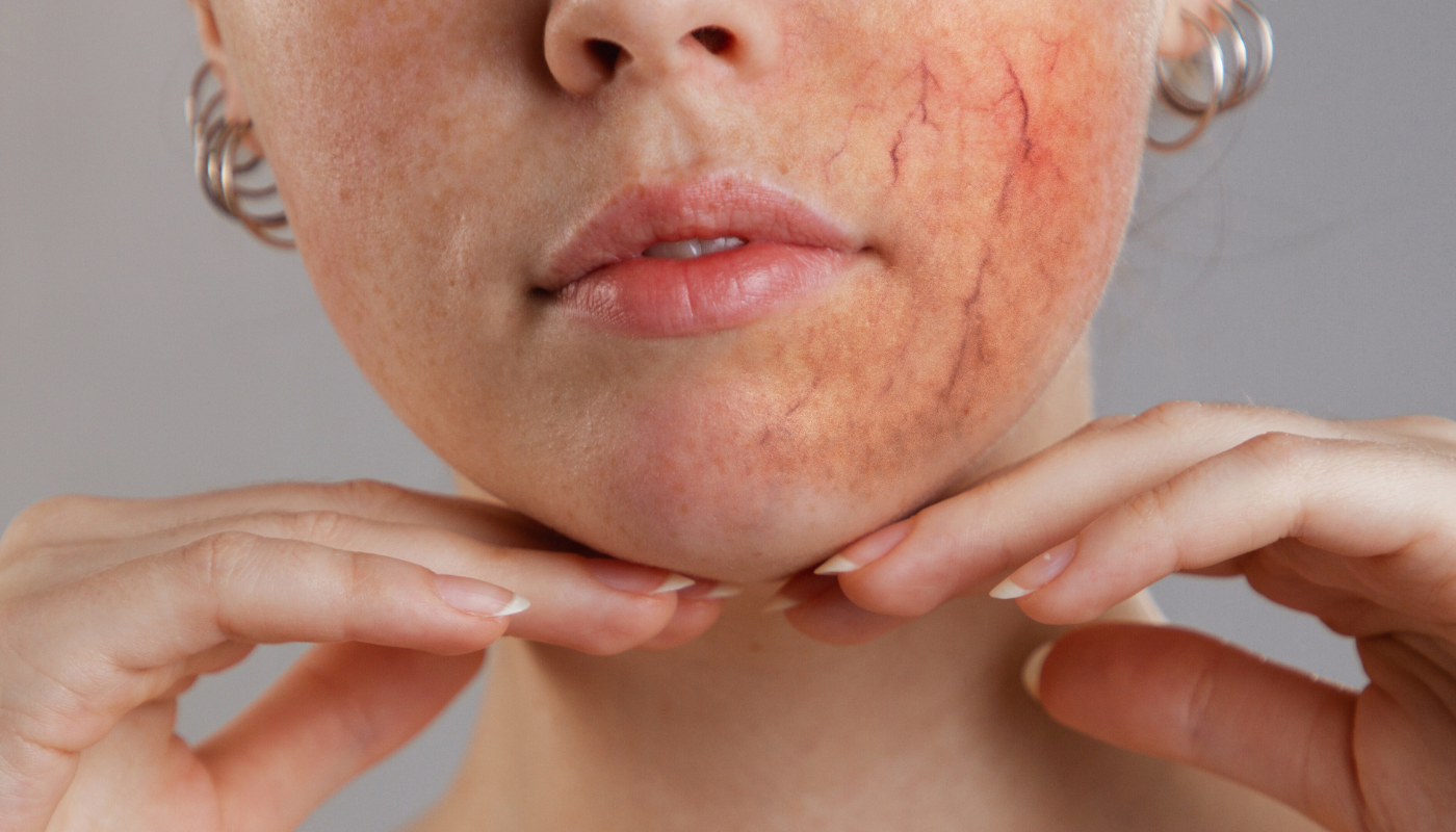 Visible Blood Vessel Under the Skin: Causes & Treatment
