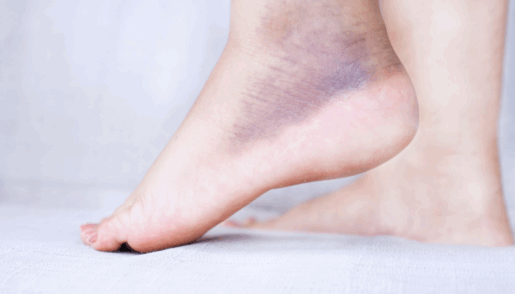 Visible Blood Vessel Under the Skin: Causes & Treatment